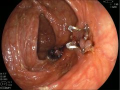 OTSC CLIPによる日帰り内視鏡的瘻孔閉鎖術 | 芦屋三戸岡クリニック